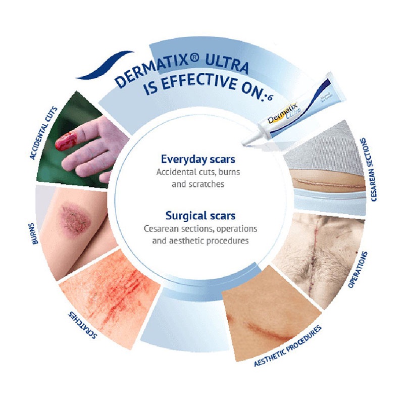 Original Dermatix Effective Scar Removal Cream Scar Gel Old Scars Acne ...