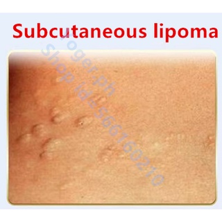 30g/box Herbal Lipoma Health Cream Remove Lipoma Lipomatosis Fibroma ...