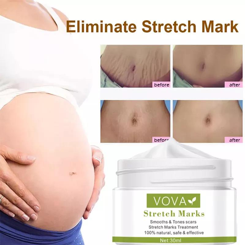 Pregnancy Repair Cream Stretch Mark Removal Removal Acne Scar Stretch