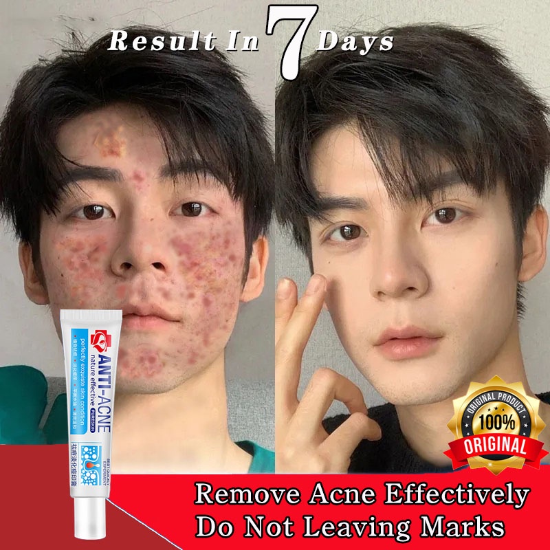 Pimple Remover Cream Scar Remover Cream Skin Care Products Anti Acne ...