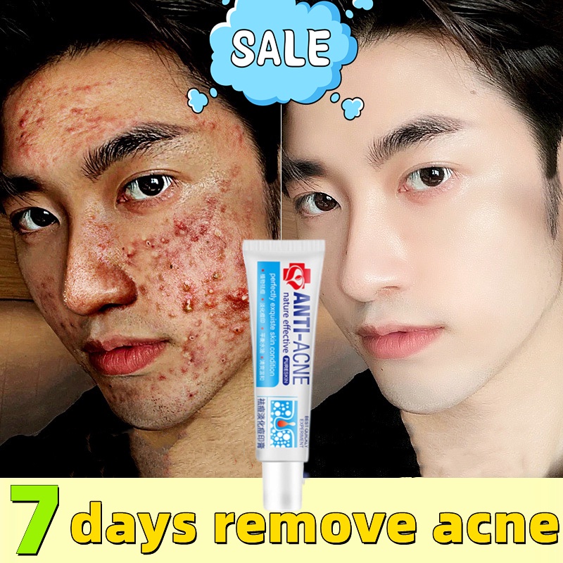 anti acne cream pimple cream acne remover cream acne care pimples and ...