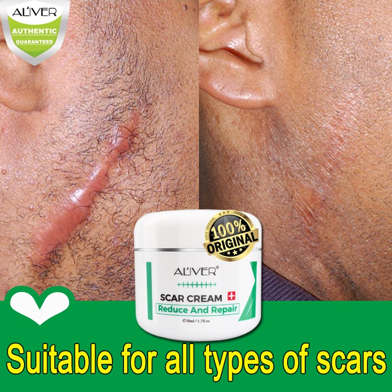 Aliver Scar Remover Cream Original For New And Old Scars Whole Body 50g