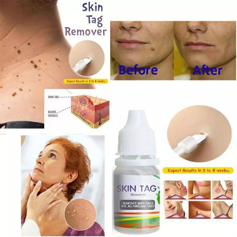 Medicinal Plaster Treatment for Corn Plantar Wart Removal Foot Care ...