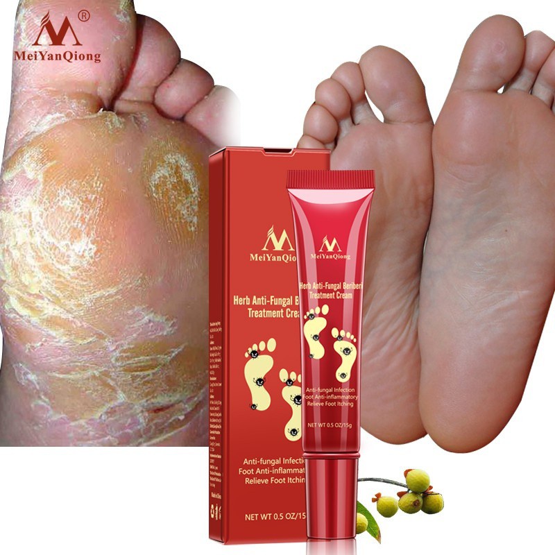 Foot Cream Anti-Fungal Infection Foot Relieve Foot Itching Cream ...
