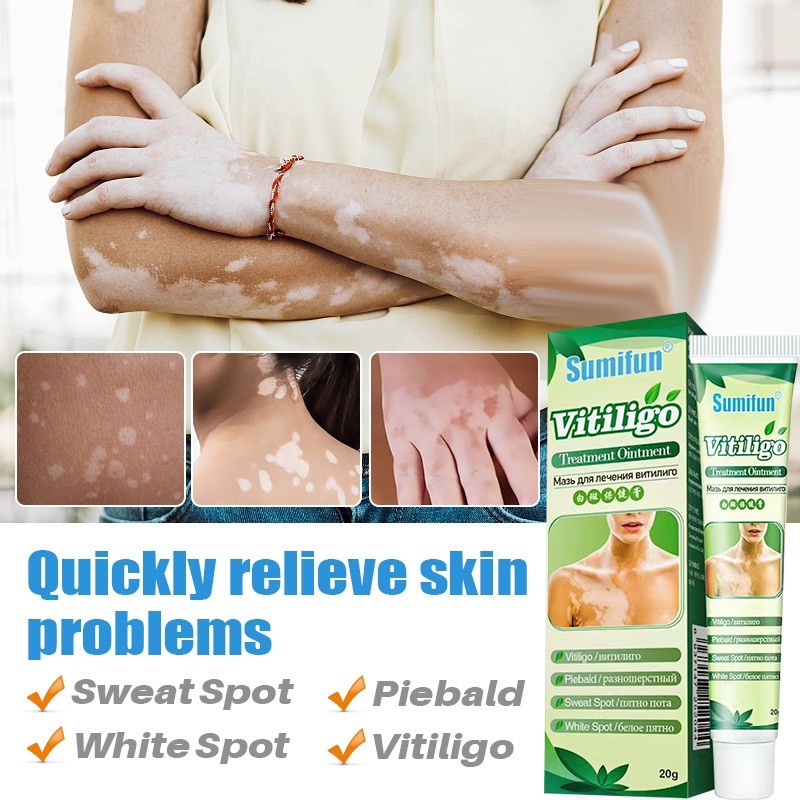 Vitiligo Cream Vitiligo Treatment Cream White Spots Tag / Kulugo ...