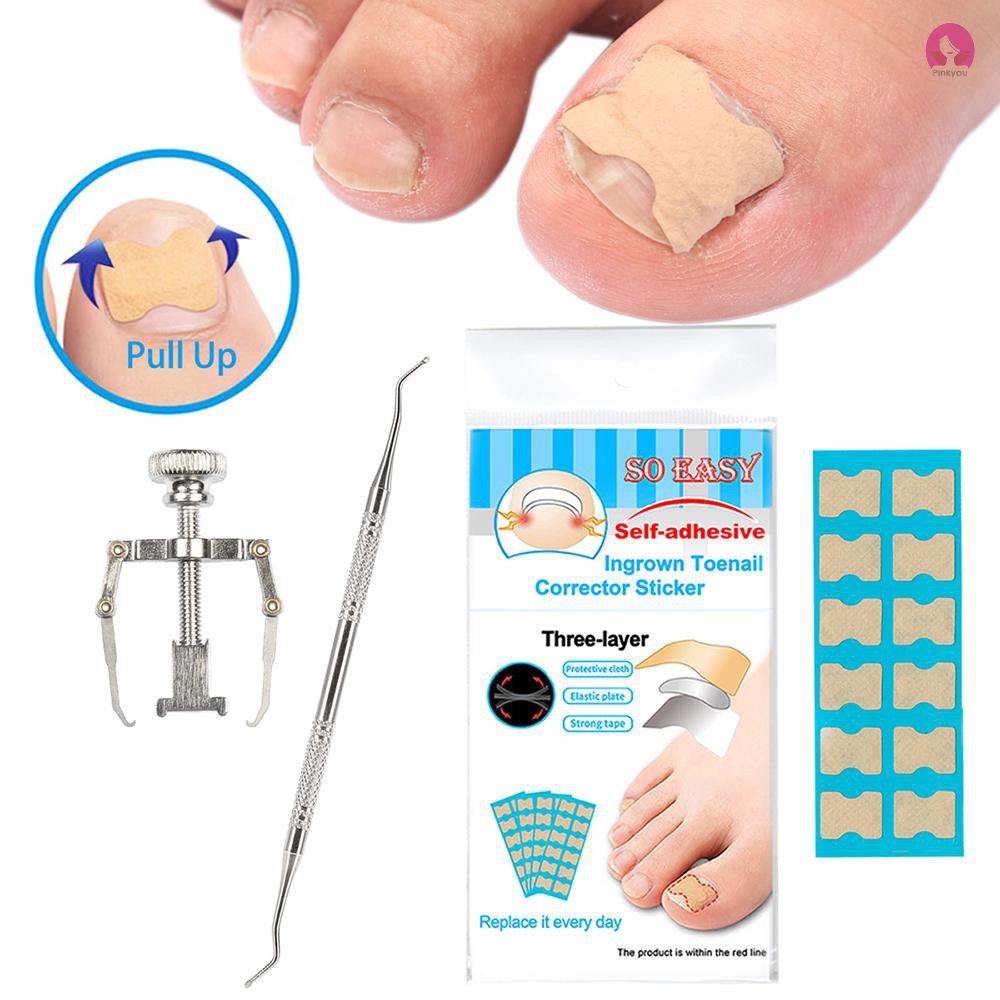 Ingrown Nail Correction Kit Ingrown Toenail Stickers Toe Nail Clamp ...
