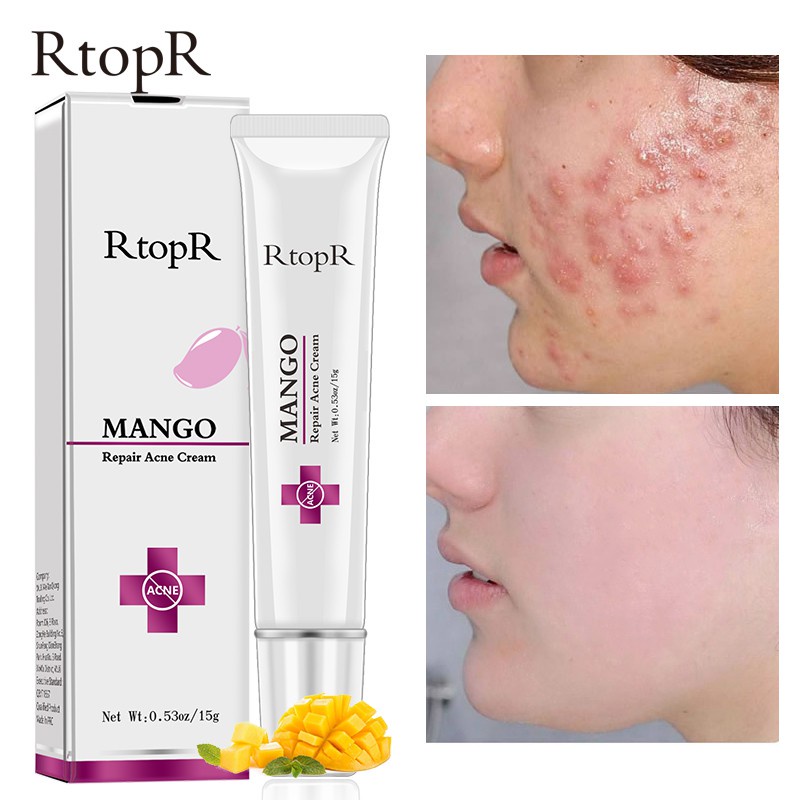 Mango Acne Treatment Cream Blackhead Repair Gel Serum Control Shrink ...