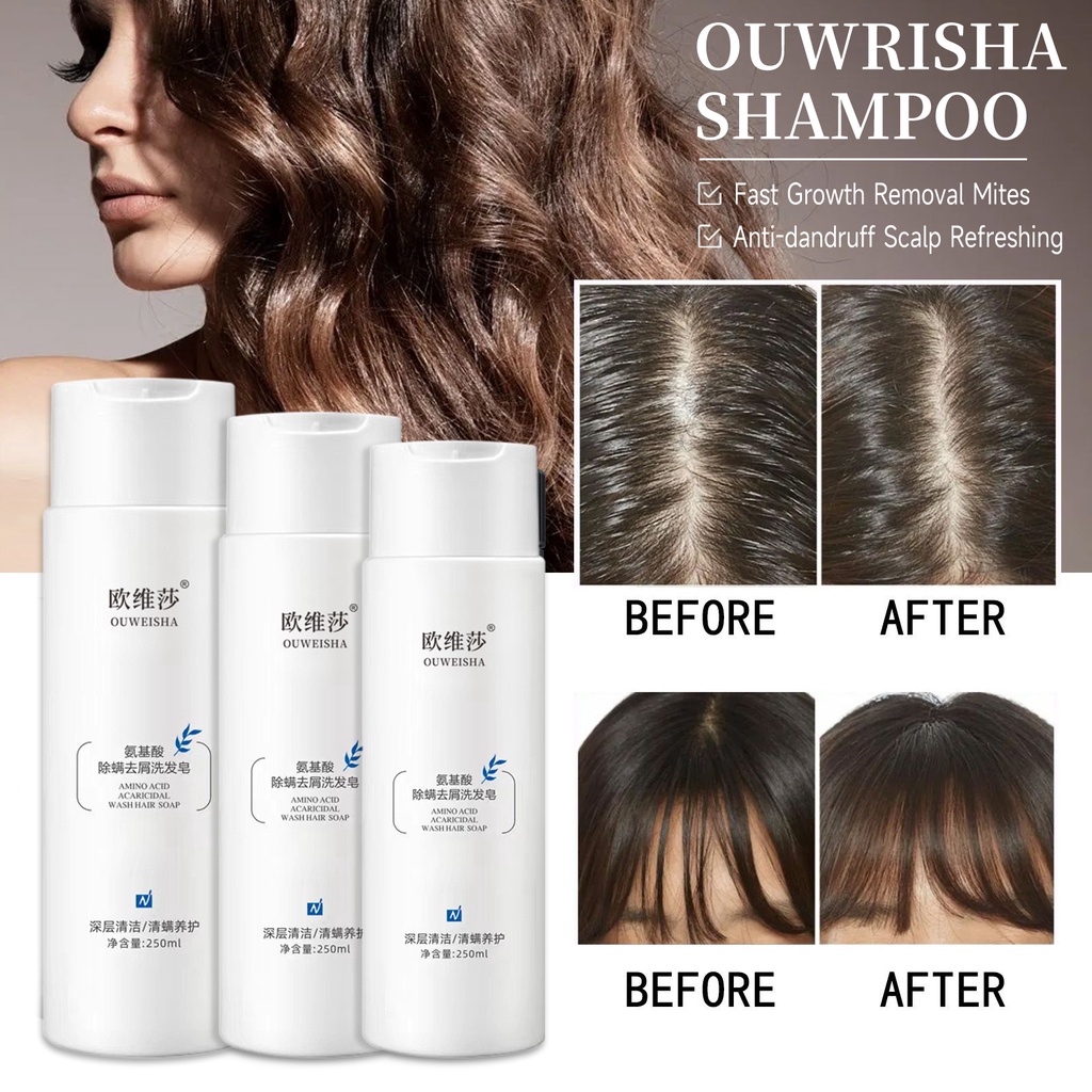 Amino Acid Anti-Dandruff Shampoo Soap Acaricidal Wash Hair Soap Mite ...