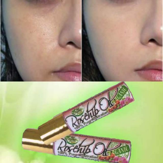 Pangtanggal ng Peklat | Scar Eraser | Removes Acne Marks | Organic ...