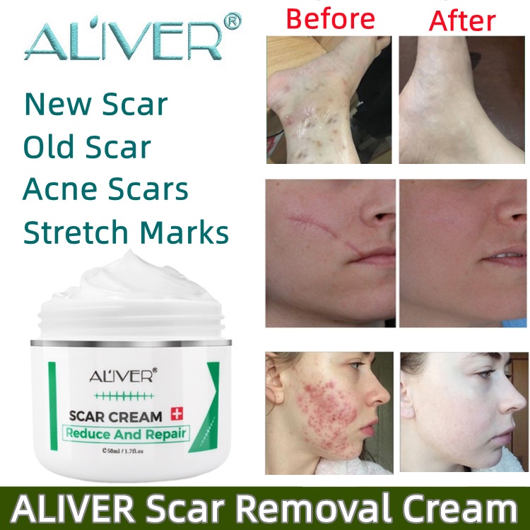 ALIVER Scar Repair Cream Remove Acne Scar remover Stretch Mark Scald ... ALIVER Scar Repair Cream Remove Acne Scar remover Stretch Mark Scald ...