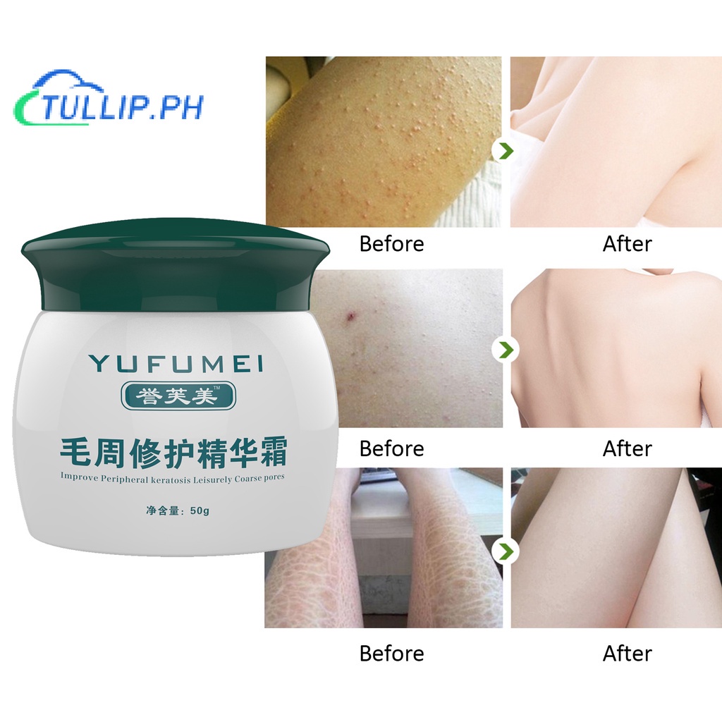 50g Curing Keratosis Pilaris Kp Chicken Skin Body Lotion Repair Cream