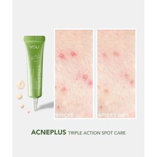 acneplus - Best Prices and Online Promos - Jan 2023 | Shopee Philippines