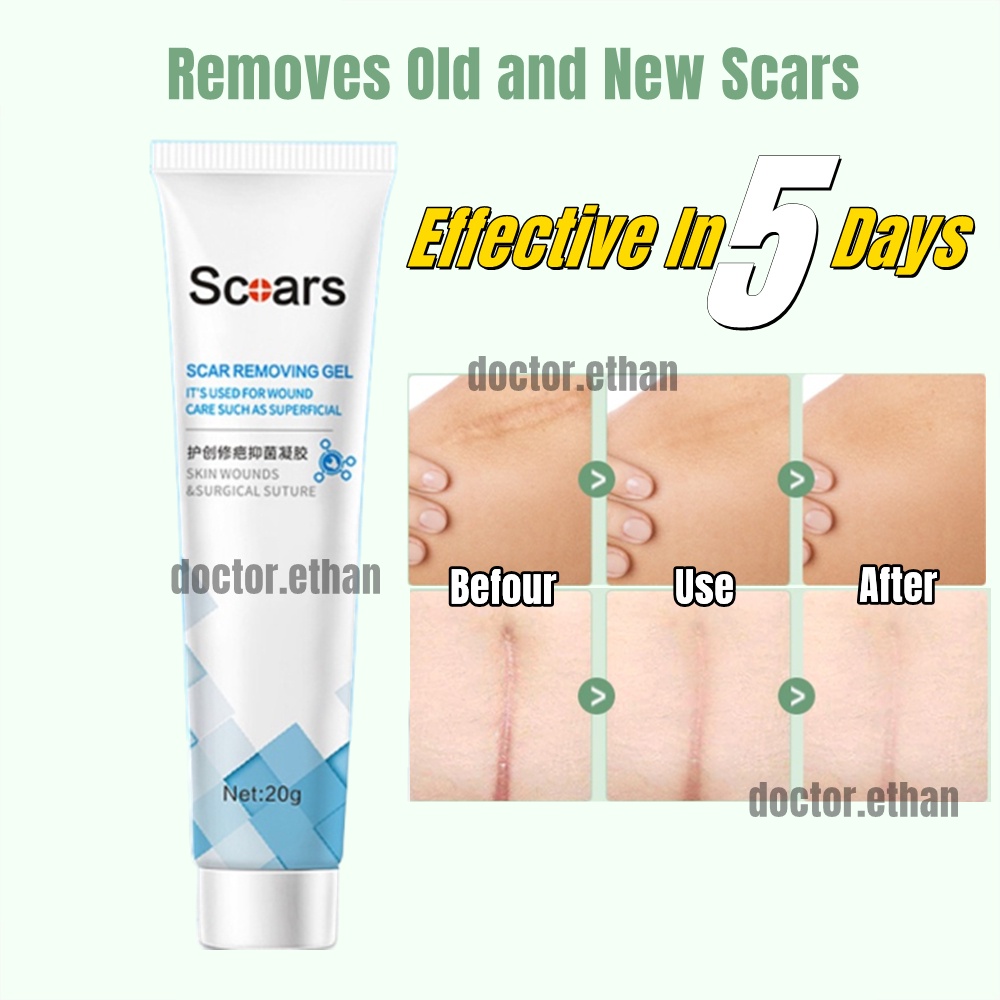Scar Removal Cream Peklat Remover Acne Scars Treatment Stretch Mark ...