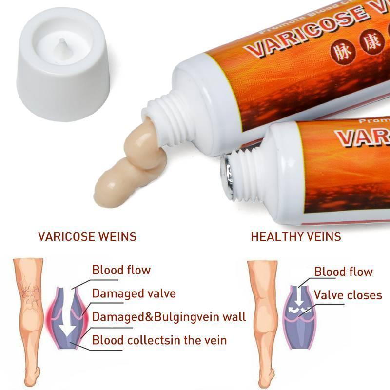 Sumifun Varicose Veins Cream Treatment Vasculitis Phlebitis Spider Leg