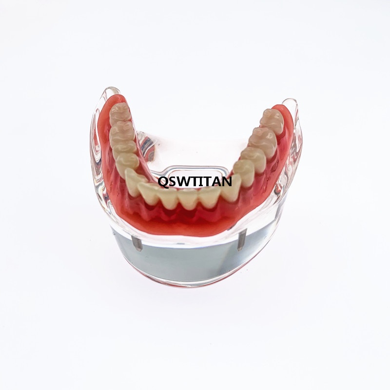 Dental Overdenture Teeth Model with 2 Implant/4 Implant Removable ...