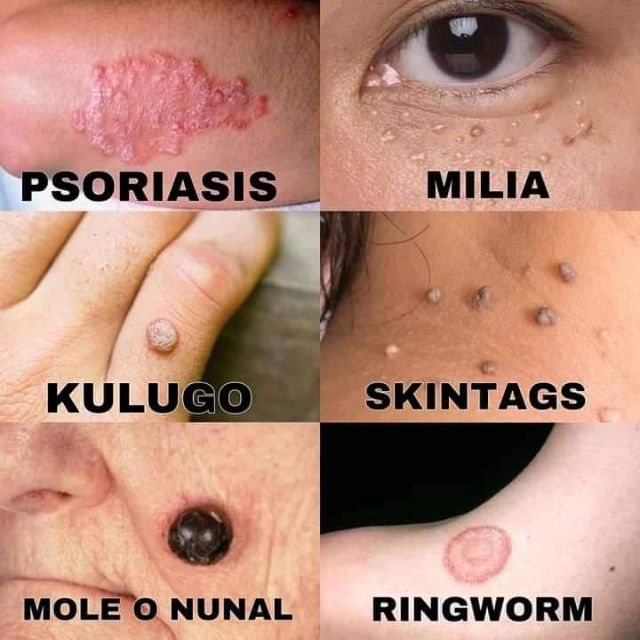 WARTS MASTER, Online Shop | Shopee Philippines