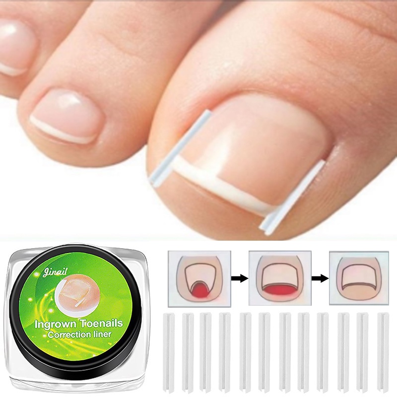 10pcs/bottle Nail Groove Ingrown Nail Correctors Ultra-thin C-shaped ...