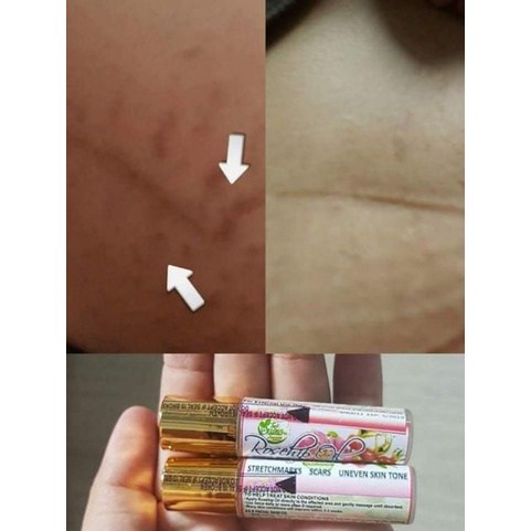 Pangtanggal ng Peklat | Scar Eraser | Removes Acne Marks | Organic ...