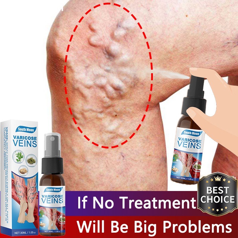 Varicose Spray Varicose Vein Remover treatment Varicosity Angiitis ...