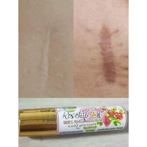 Pangtanggal ng Peklat | Scar Eraser | Removes Acne Marks | Organic ...