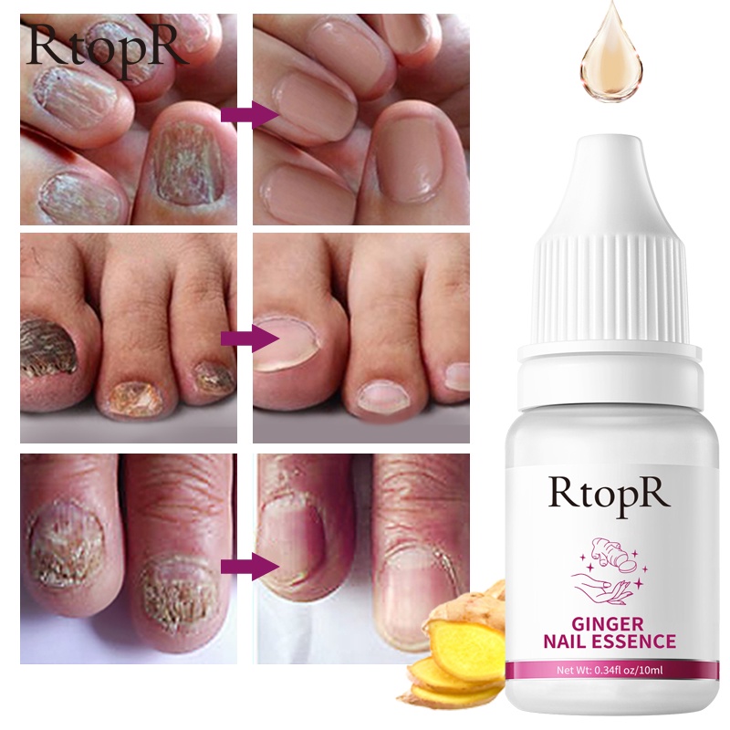 RtopR 10ml Herbal Foot Repair Ginger Antibacterial Nail Treatment ...