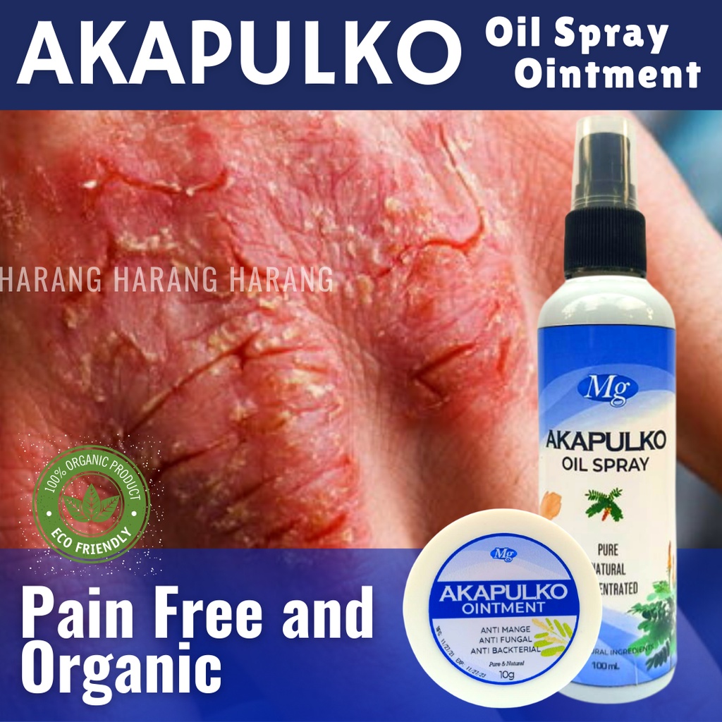 AKAPULKO OIL | Bundle Set Spray and Ointment | Treat Different Skin ...