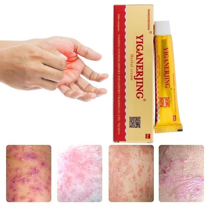Psoriasis Eczema Ointment Skin Rash Minor Disease Chinese Herbal ...