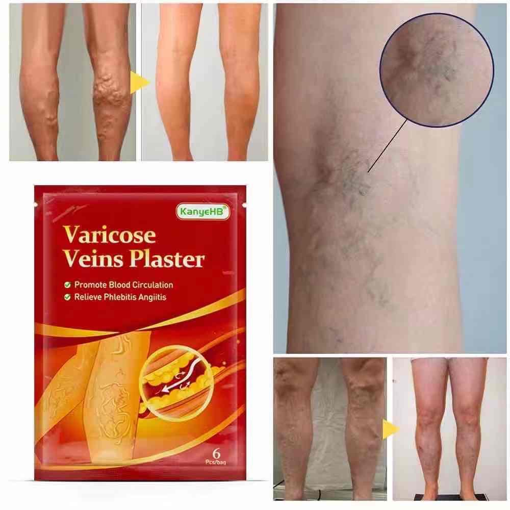 6pcs/bag Pain Relief Relievers Knee Patches Muscle Health Care Varicose ...