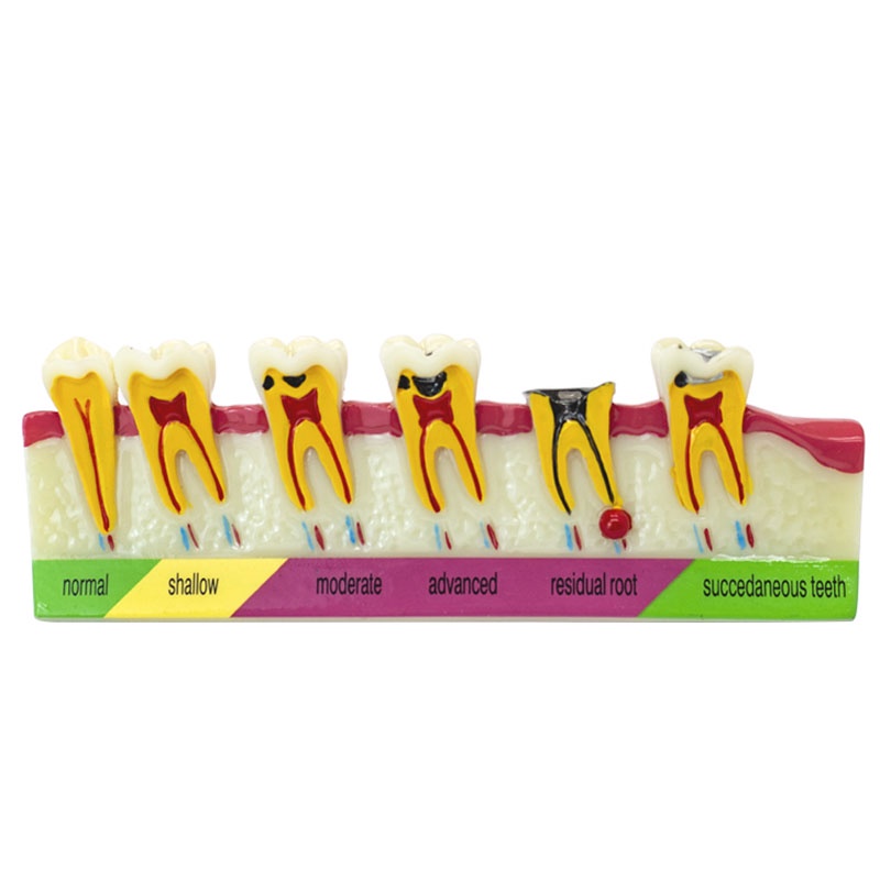 Teeth Caries Classify Tooth Model of Pathological Process Around Teeth ...