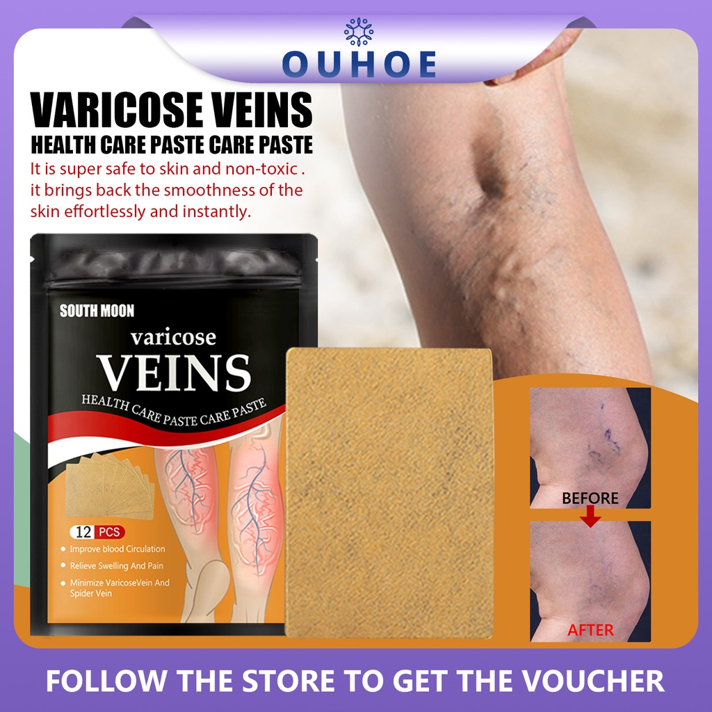 South Moon Varicose Veins Patch, Leg Health Care Paste,Phlebitis ...