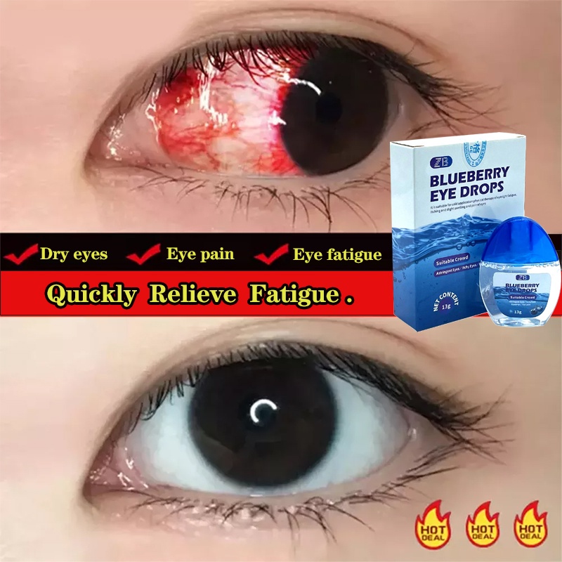 Blueberry Eye Drop Relieves Red Eyes Discomfort Blurred Vision Dry ...