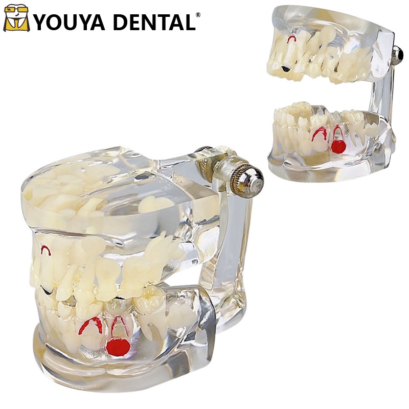 Children's Deciduous Permanent Tooth Pathological Model With Caries ...