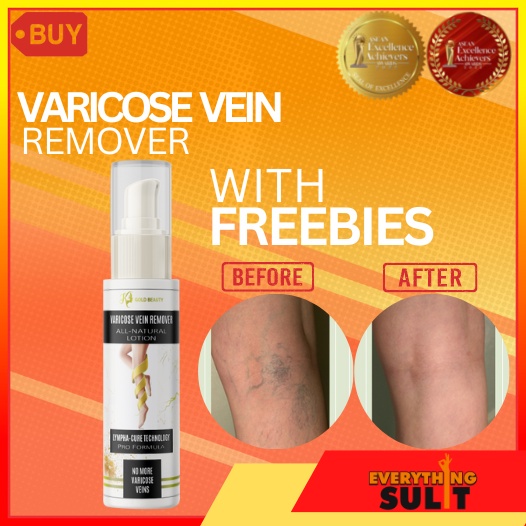 Varicose Veins Remover Cream By K Gold Beauty WITH FREEBIES - Varicose ...