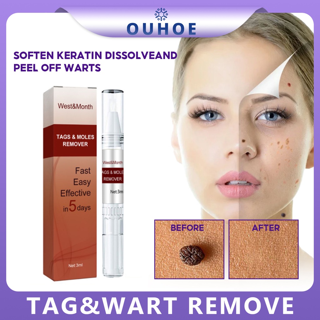West&Month west month wart remover Removal Wart Removal Mole Cream Wart ...