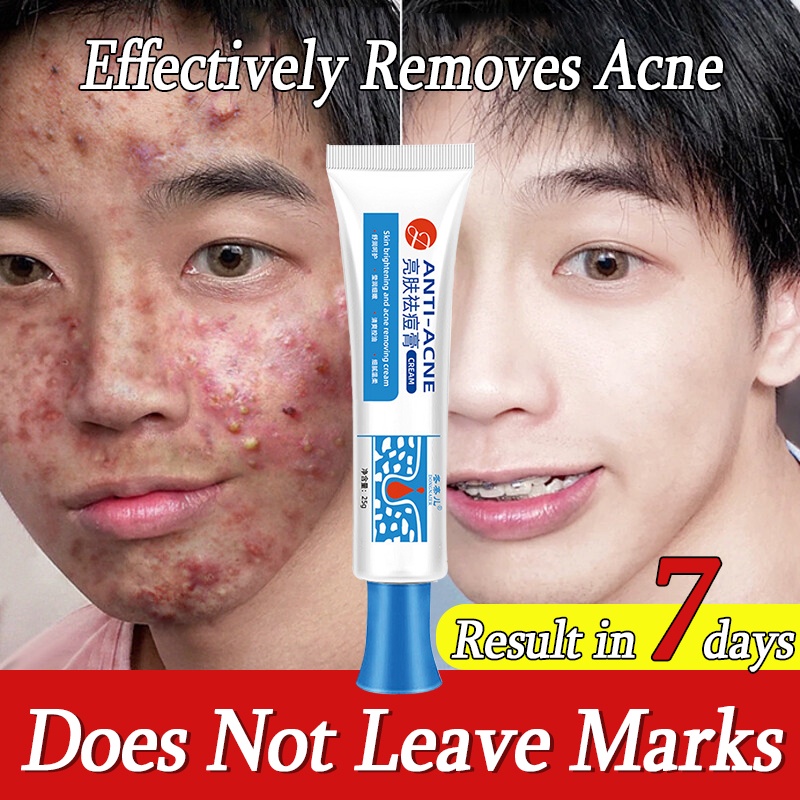 Acne Cream Pimple Remover Cream Acne Remover Pimple Scar Remover Acne ...