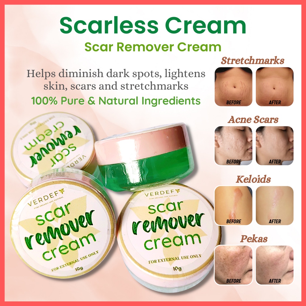 Scar Remover Cream/Keloid & Stretchmark Remover Cream by VERDEFY ...